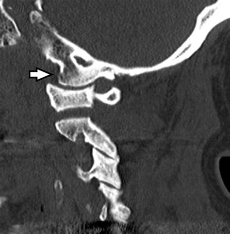 Atlanto Occipital Joint Xray