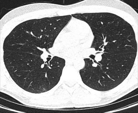 Follow Up Thoracic Computed Tomography Revealing Near Complete