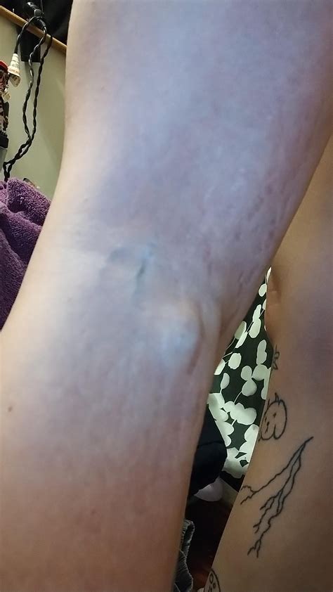 Axillary And Inguinal Lymph Node Swelling 7 Years With Pics Rdiagnoseme