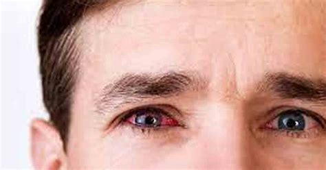 Steps To Prevent Conjunctivitis Check Details Here Pune Pulse