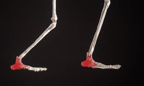 What Is Plantar Fasciitis Symptoms Causes And Treatment