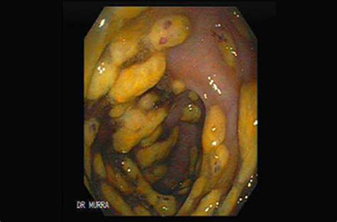 Cdc Clostridium Difficile Colitis