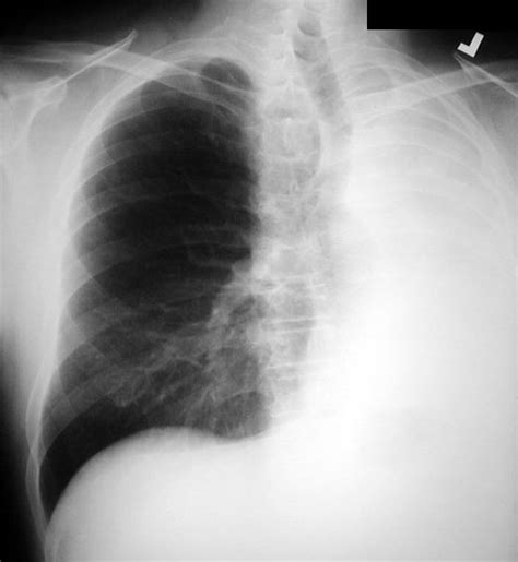 Pneumonectomy Lung Volume Reduction