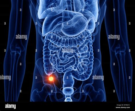 Appendix Cancer Cancerwalls