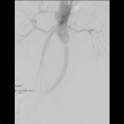 Angiography Showing A Femorofemoral Crossover Bypass Download