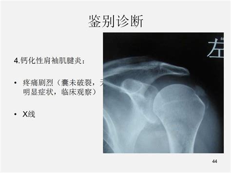 肩袖损伤的诊断与治疗技巧 好医术文章 好医术 赋能医生守护生命 肩袖损伤的诊断与治疗技巧 好医术文章 好医术 赋能医生守护生命