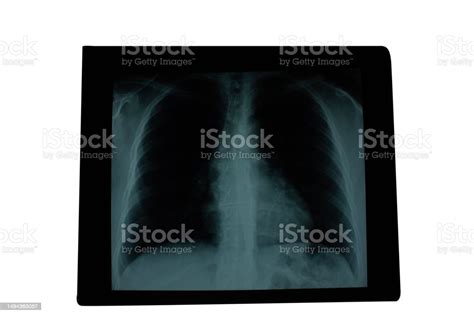 Xray Lungs Radiological Image Of Patient Lung Parenchyma Homogeneous Radiographic Pattern And