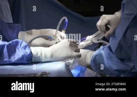 Laparoscopic Lung Surgery Stock Video Footage Alamy