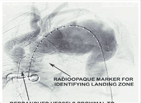 Aortic Root Angiogram Pre Evar Indicating The Debranched Vessels And Download Scientific