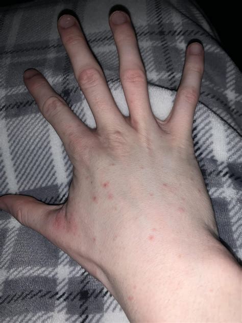 Is This Scabies Help I Just Cant Stop Itching Rscabies