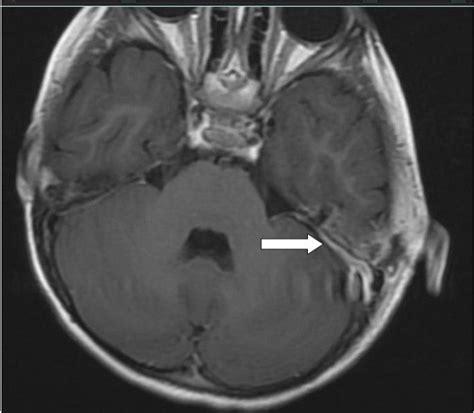 Mastoiditis And Gradenigos Syndrome With Anaerobic Bacteria Bmc Ear