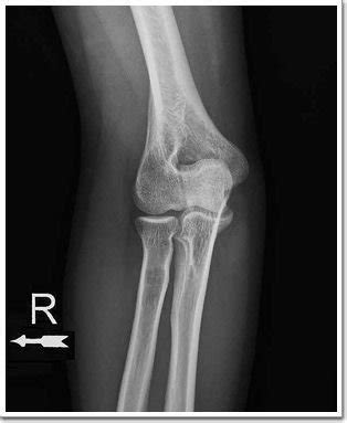 X Ray Elbow Lateral
