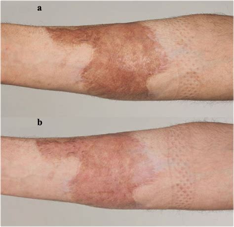 26 Year Old Male With A 16 Month Old Scald Burn To The Right Forearm