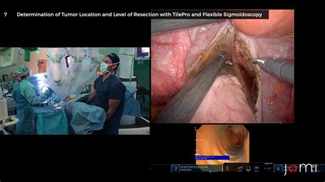 Robotic Low Anterior Resection With Diverting Loop Ileostomy For