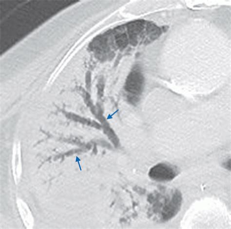Fleischner Society Glossary Of Terms For Thoracic Imaging Radiology Key