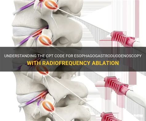 Understanding The Cpt Code For Esophagogastroduodenoscopy With