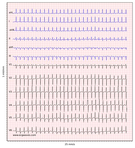Atrial Flutter Classification Causes ECG Diagnosis Management