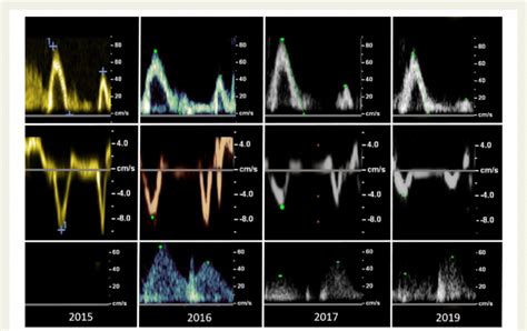 Diastolic Function Parameters E A Ratio E 0 Septal And Pulmonary