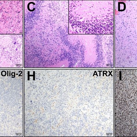 Histological Analysis Of Diffuse Hemispheric Glioma H3 G34 Mutant Download Scientific Diagram
