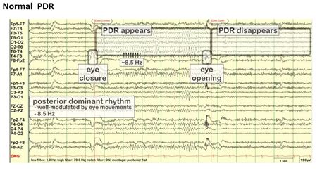 Abnormal Eeg PPTX