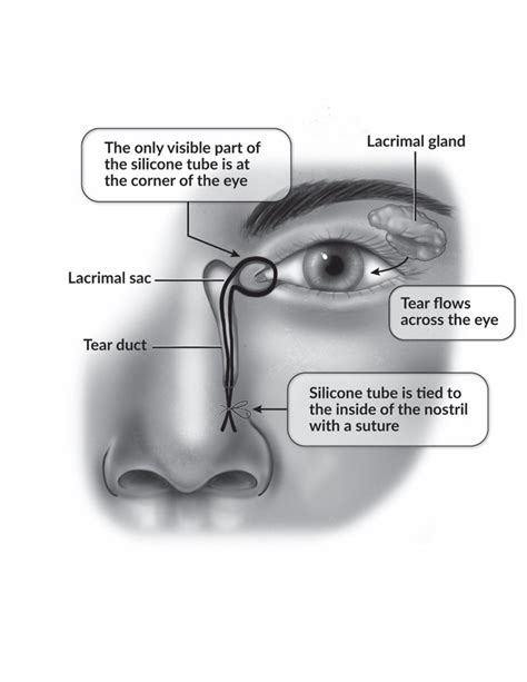 Clogged Lacrimal Duct