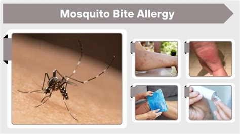Mosquito Bite Allergy Symptoms Pictures And Treatment