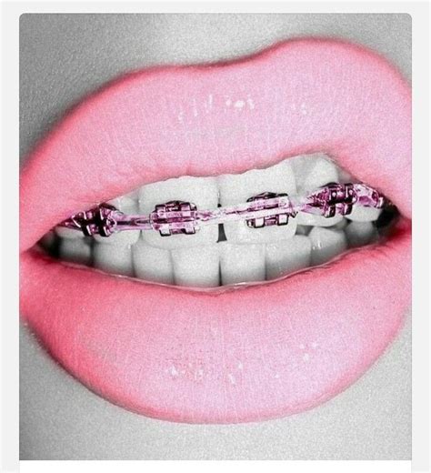 Pink Dental Braces Teeth Braces Braces Smile Adult Braces Pink