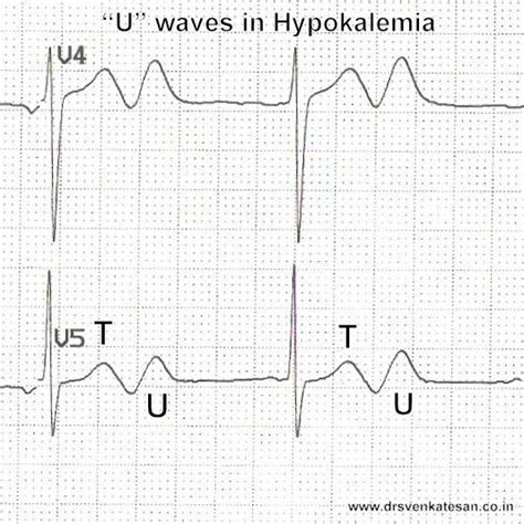 When Sinus Bradycardia Accompanies Hypokalemia “u” Waves Appear In A