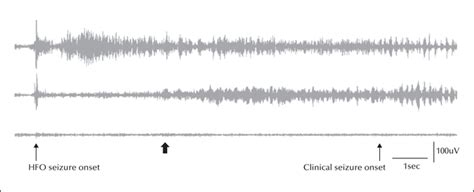 Jle Epileptic Disorders Interictal High Frequency Oscillations