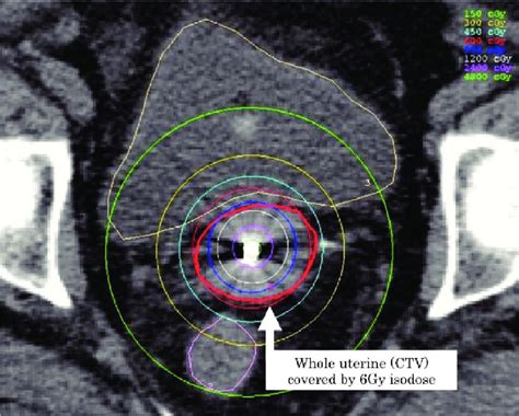 Dose Distribution In An Axial Ct Image On Brachytherapy Thick Red Line Download Scientific