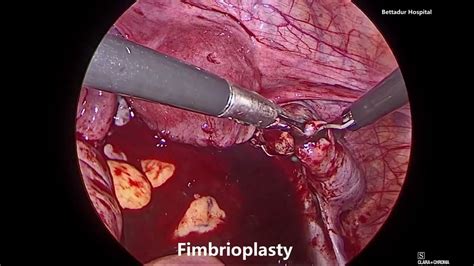 Fimbrioplasty For Fimbrial Block Due To Pid Youtube