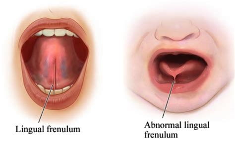 Frenulum Types Abnormality And Treatment Simply Healths