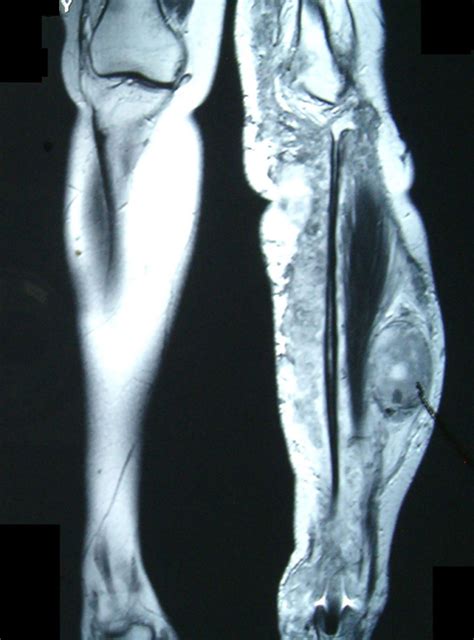 Mri Image Showing The Site Of The Tumor In The Left Tibia Case 1