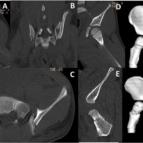 Pre Operative Computerized Tomography Scan Of The Pelvis A B C Download Scientific Diagram