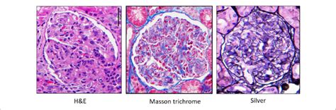 Glomeruli With Global Endocapillary Hypercellularity With Leukocytes