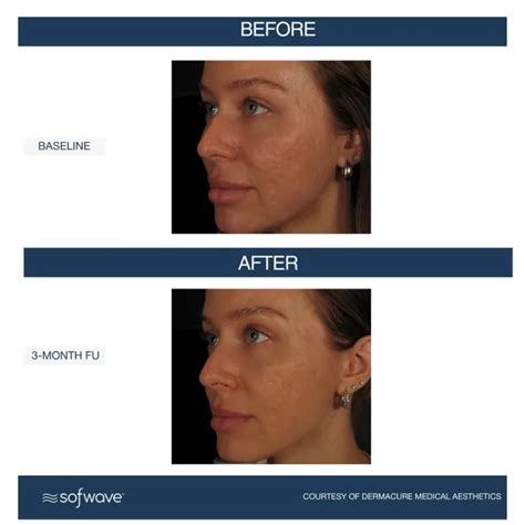 Sofwave Skin Rejuvenation Santa Rosa And Healdsburg