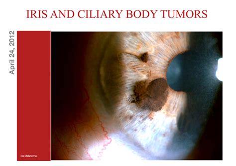 Better Treatment Option For Tumors Of The Iris New York Eye Cancer Center