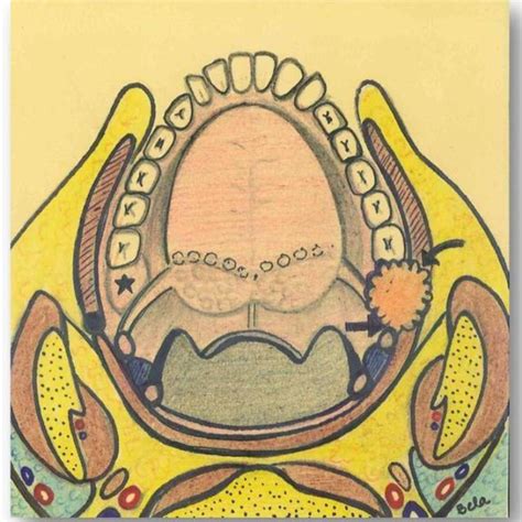Pdf Imaging In Squamous Cell Carcinoma Of The Retromolar Trigone