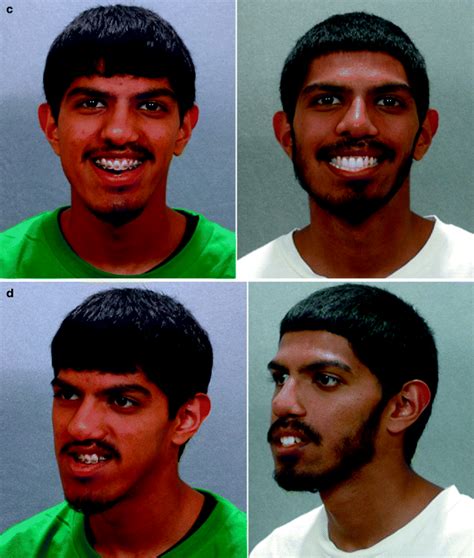 Cleft Jaw Deformities And Their Management Pocket Dentistry