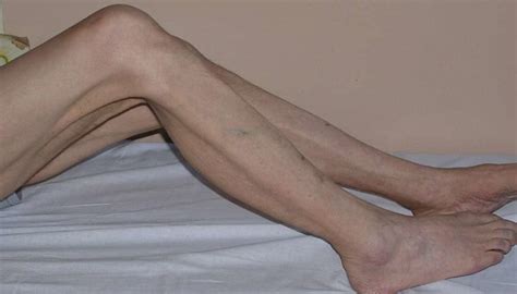 Muscle Atrophy Pictures Muscle Muscle Atrophy Stiwell Feb 22 2020