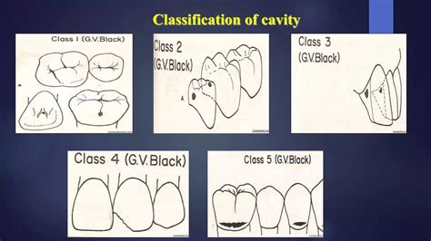 Class I Ii Composites Cavity Preparations Pptx