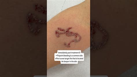 Bleeding After Tattoo