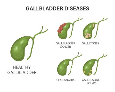 Premium Vector Gallbladder Diseases Infographics Gallstone Disease