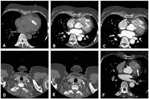 A Rare Case Of An Intracardial Ectopic Thyroid In The Right Ventricle