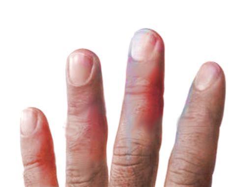 Pernio Treatment And Management Point Of Care