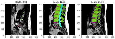 Github Cdoswald Spider Spinal Mri Dataset Curation And Semantic Segmentation Tutorial