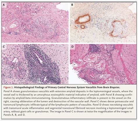 Vasculite PrimÁria Do Snc Neurosky