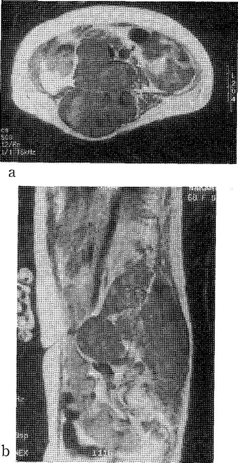 Figure 1 From Peripheral Primitive Neuroectodermal Tumor Involving The Paravertebral And