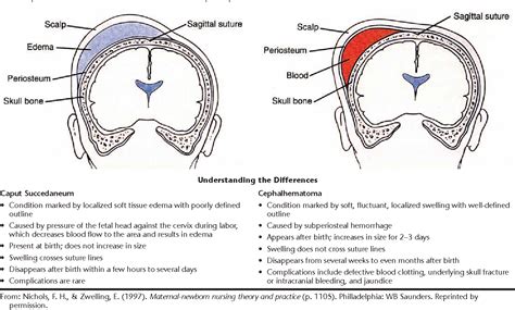 Cephalohematoma Caput Succedaneum And Epidural Hematoma Image My Xxx