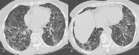 Nsip Pattern Typical Nsip Pattern In A 78 Year Old Woman Consisting Download Scientific